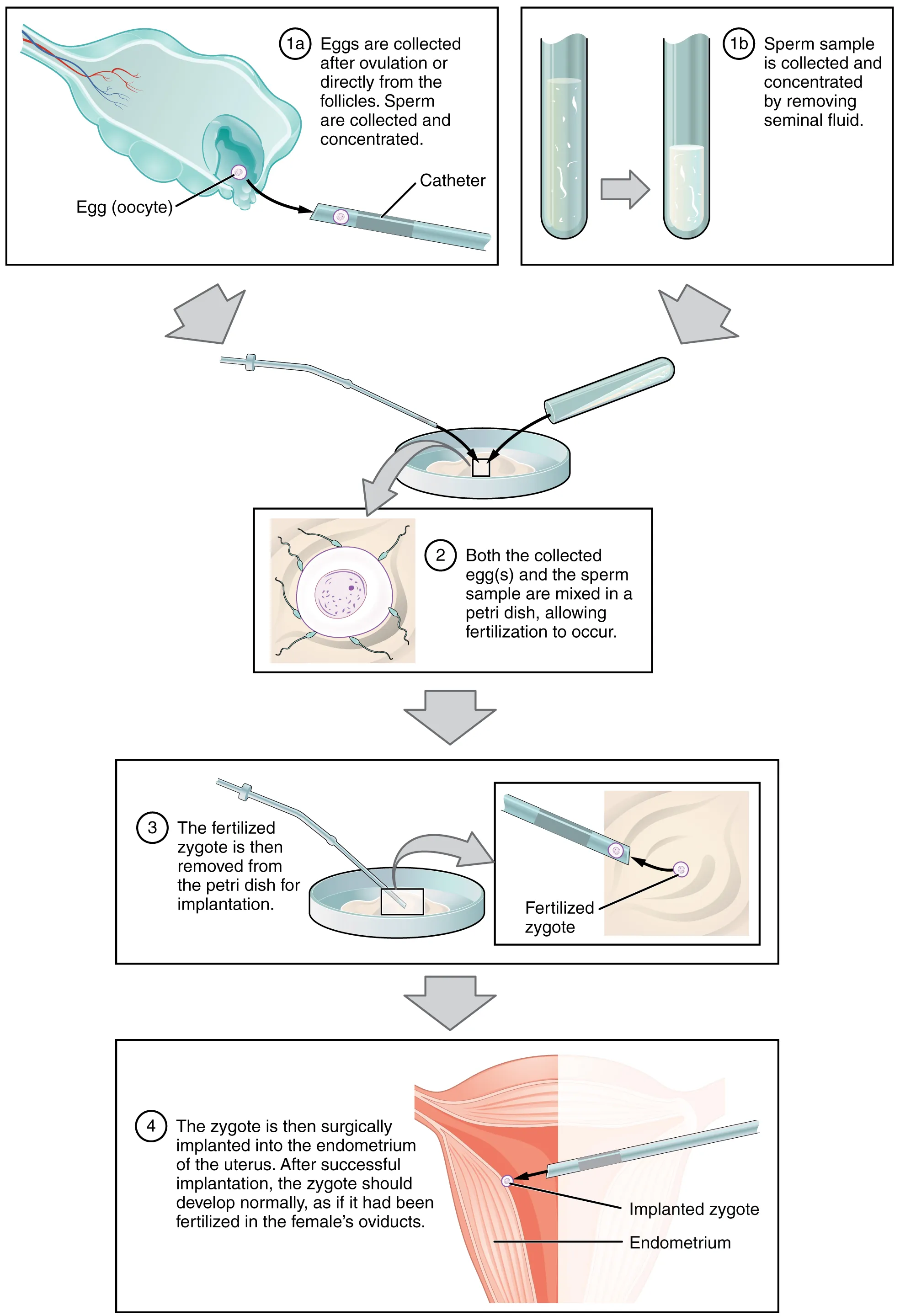 In Vitro Fertilization Diagram